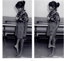 Rotationplasty Video