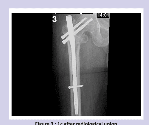 Figure 5 from Comparative Study of Helical Blade PFN and Double Hip ...