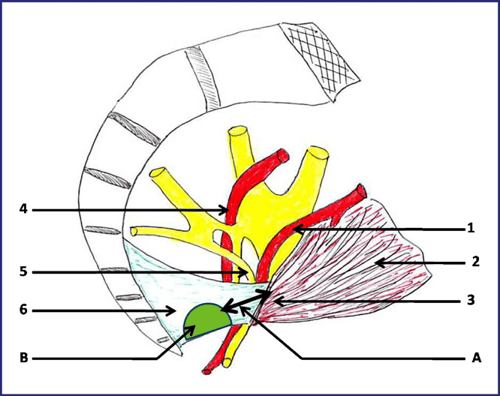 [Mini-invasive posterior sacrospinous ligament fixation using the CAPIO ...