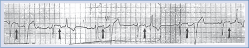 Figure 1 from Alternating bundle branch block during atrial bigeminy ...