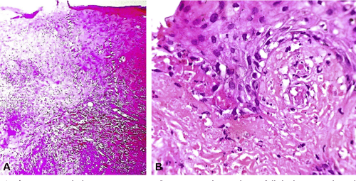 Table I from A fatal case of febrile ulceronecrotic Mucha-Habermann ...