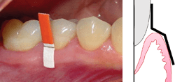 Figure 1 from Gingival Crevicular Fluid | Semantic Scholar