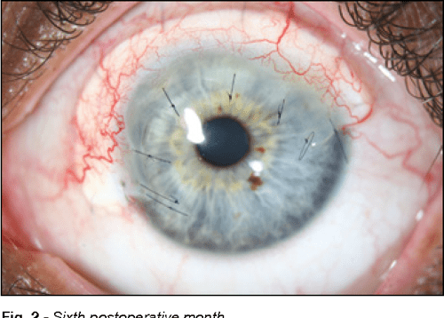 Figure 2 from Fuchs’ Superficial Marginal Keratitis Managed with ...