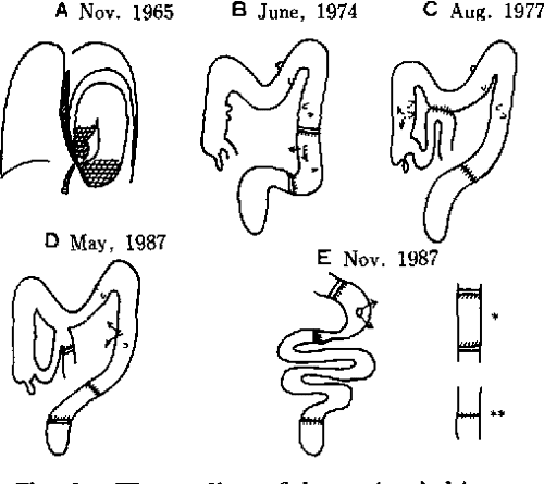 Ehlers-danlos syndrome complicated by eventration of the diaphragm ...