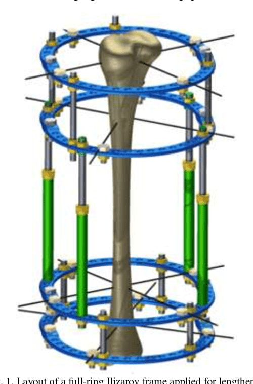[PDF] Ilizarov K-wire tensioning device with tapered spring grip ...