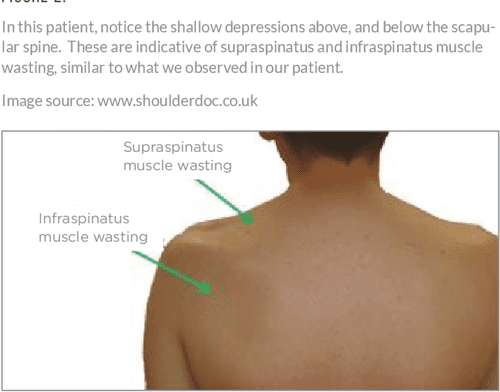 Parsonage Turner Syndrome | Semantic Scholar