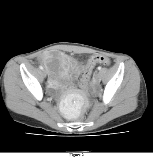 Perforated cecal diverticulitis - A review of an unexpected diagnosis ...