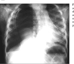 [PDF] Fallen lung sign: radiographic findings. | Semantic Scholar