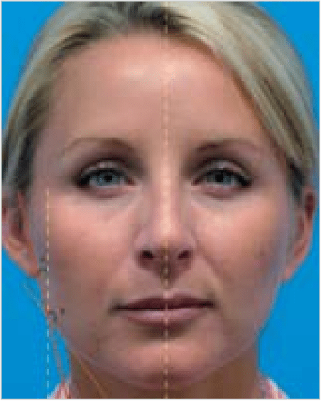 Figure 1 from Nonsurgical reshaping of the lower face. | Semantic Scholar