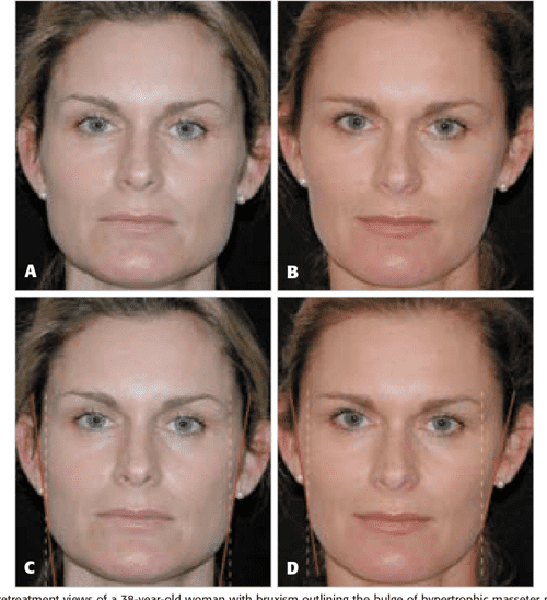 Figure 1 from Nonsurgical reshaping of the lower face. | Semantic Scholar