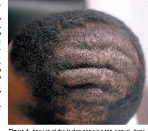 Figure 1 from Cutis verticis gyrata secondary to a cerebriform ...