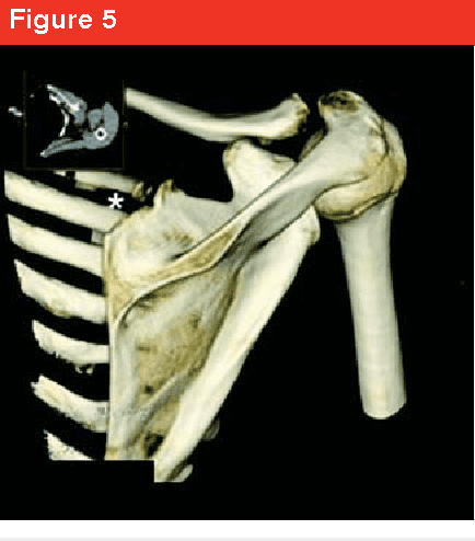 Figure 1 from Snapping Scapula Syndrome: Diagnosis and Management ...