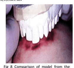 BITE MARK ANALYSIS IN FORENSIC ODONTOLOGY | Semantic Scholar