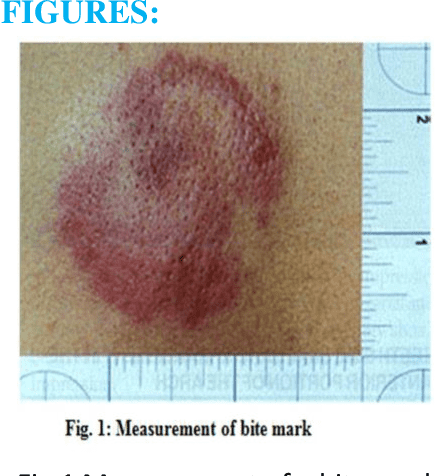 Figure 6 from BITE MARK ANALYSIS IN FORENSIC ODONTOLOGY | Semantic Scholar