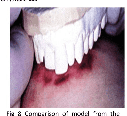 BITE MARK ANALYSIS IN FORENSIC ODONTOLOGY | Semantic Scholar