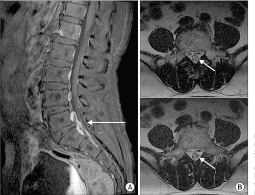 Figure 4 from Cauda Equina Syndrome Occurred by Adhesive Arachnoiditis ...