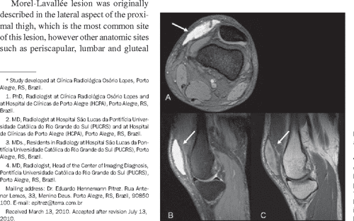 Figure 2 from Morel-Lavallée lesion in the knee: a case report* Lesão ...