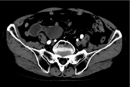 Figure 2 from Preoperative Diagnosis and Surgical Approach of ...