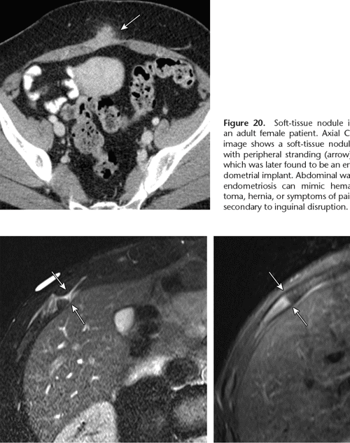 Figure 2 from Don't Forget the Abdominal Wall: Imaging Spectrum of ...