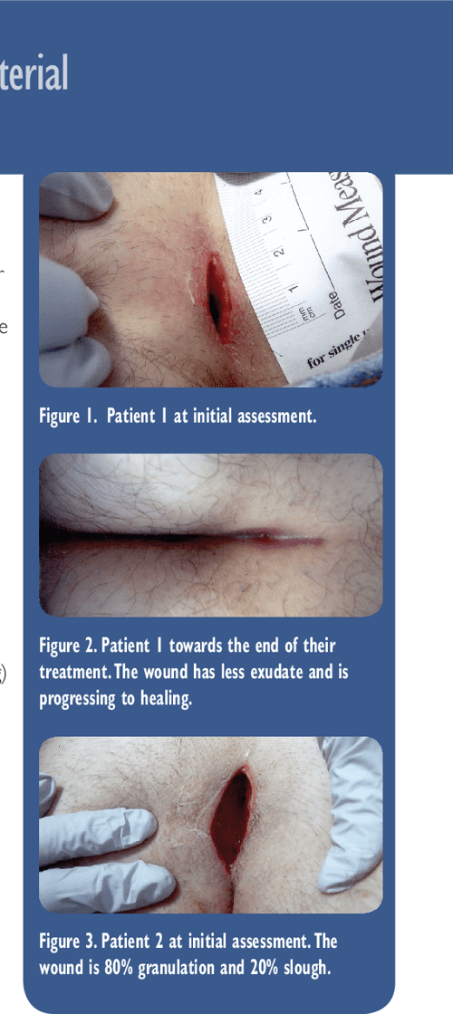 Figure 2 from Treating pilonidal sinus wounds with an antibacterial ...