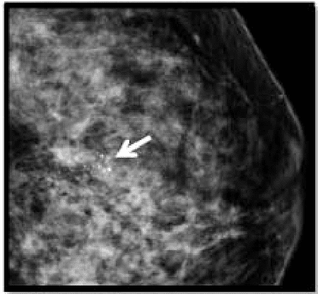 [PDF] Suspicious calcifications in BI-RADS 4 and 5 breast lesions ...