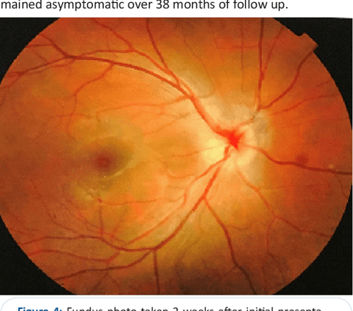 Figure 3 from Intrapapillary Hemorrhage with Adjacent Peripapillary ...