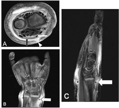 Figure 1 from MRI diagnosis of rubber band constriction syndrome ...