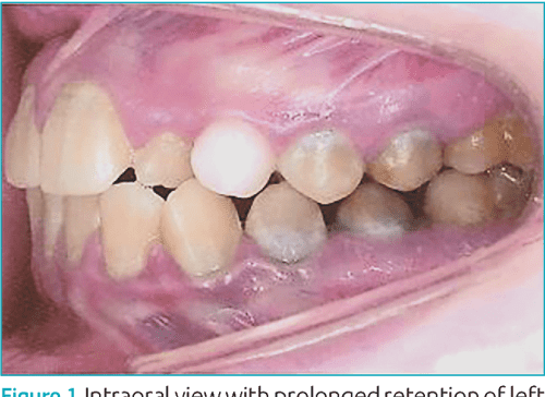Pdf Dystrophic Calcification Of Maxillary Sinus In Pediatric Patients With Liver