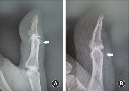 [PDF] Subungual Ganglion Cyst Mimicking Glomus Tumor | Semantic Scholar