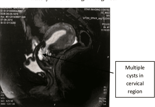 Figure 4 from An unusual presentation of nabothian cyst: a case report ...