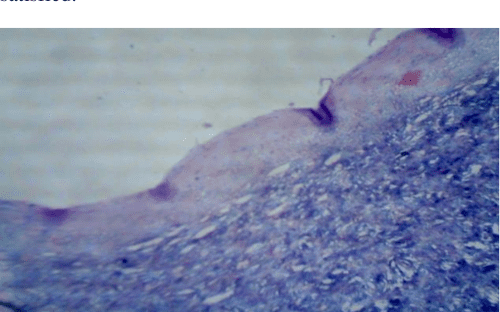 Figure 1 From An Unusual Presentation Of Nabothian Cyst A Case Report Semantic Scholar