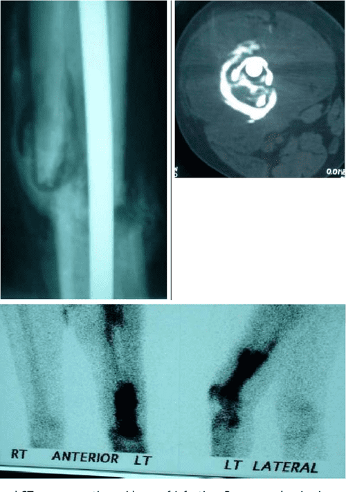 Figure 1 from Femoro-tibial turn-up-plasty (fixator assisted) for ...