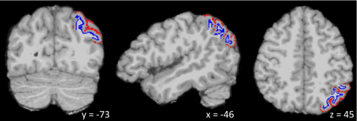 [PDF] Ventral occipito-temporal cortex function and anatomical ...