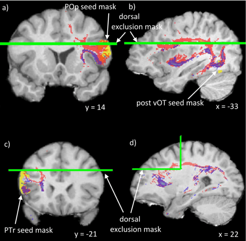 [PDF] Ventral occipito-temporal cortex function and anatomical ...