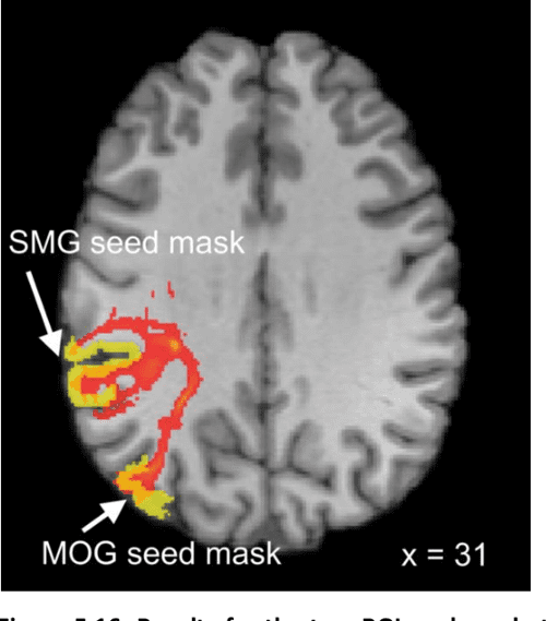 [PDF] Ventral occipito-temporal cortex function and anatomical ...