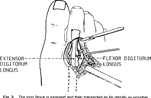 Figure 1 from Correction of Clawtoes by the Girdlestone-Taylor Flexor ...