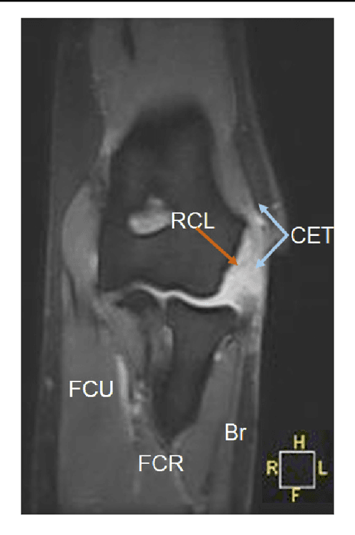 [PDF] Avulsion of the Common Extensor Tendon and Radial Collateral ...