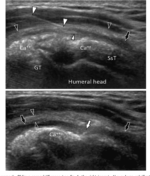US guided corticosteroid injection into the subacromial-subdeltoid ...