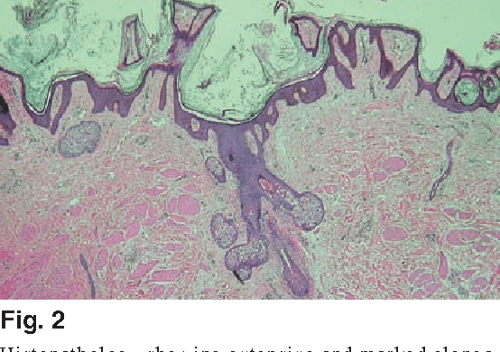 Figure 2 from Successful Treatment of Topical Tretinoin Cream in a ...