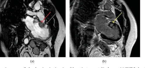 Figure 1 from An Unusual Presentation of a Myocardial Crypt in ...