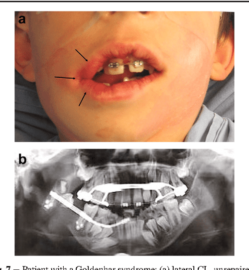 Table 2 from A classification and construction of congenital lateral ...