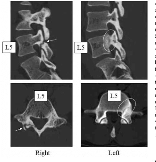 Figure 2 from Surgical management of stress fracture of the ...