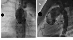 Figure 1 from Aortic valve replacement using Konno procedure for prior ...