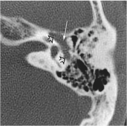 Figure 1 from The anterior epitympanic recess: CT anatomy and pathology ...