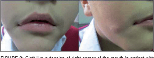 [PDF] Epibulbar Dermoid and Type 1 Duane Syndrome Coexistence in a ...