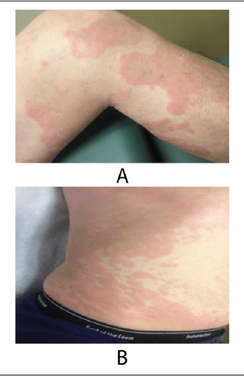 Figure 1 from Schnitzler Syndrome Without a Monoclonal Gammopathy ...