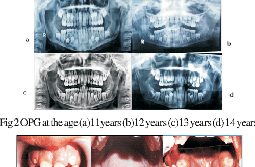 Table 1 from TOOTH SYNDROME ASSOCIATED WITH DELAYED TOOTH ERUPTION-A ...