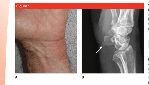 Figure 4 from Calcium Deposits in the Hand and Wrist | Semantic Scholar