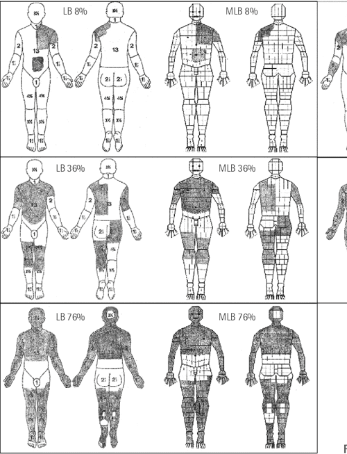 [PDF] Lund and Browder chart—modified versus original: a comparative ...