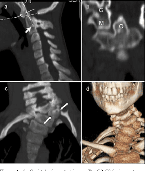 Multiple congenital vertebral anomalies identified with multidetector ...